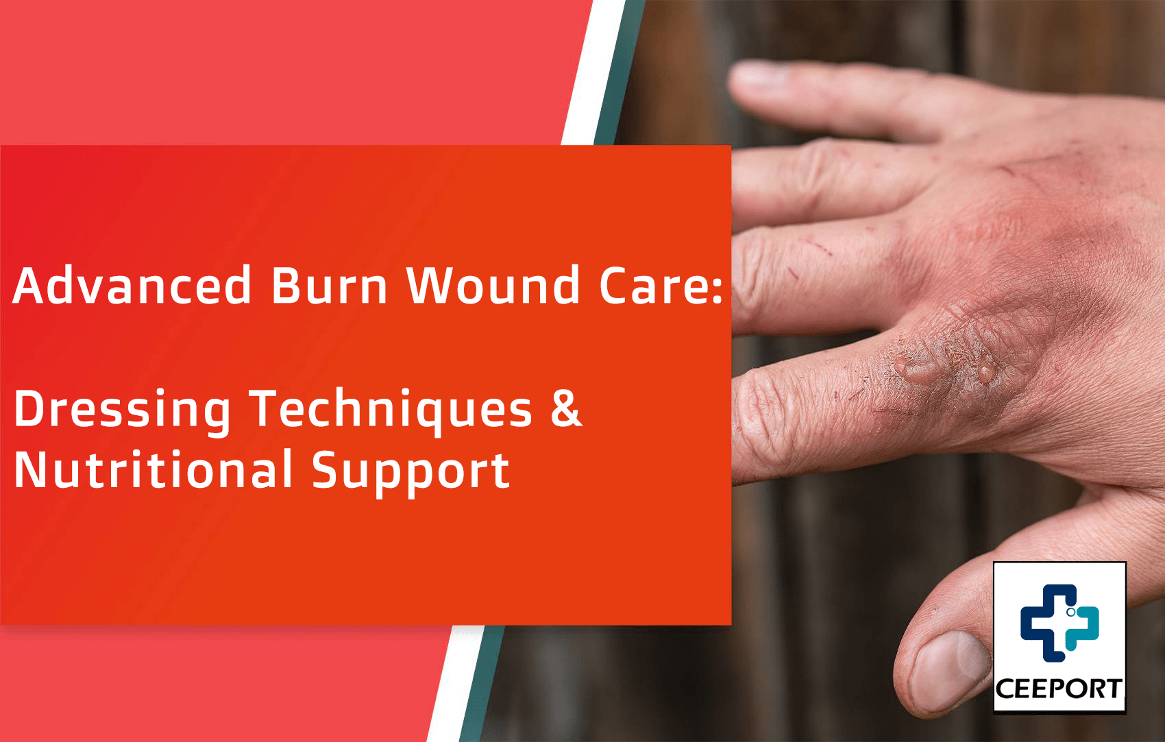 Advanced Burn Wound Care: Dressing Techniques & Nutritional Support ...