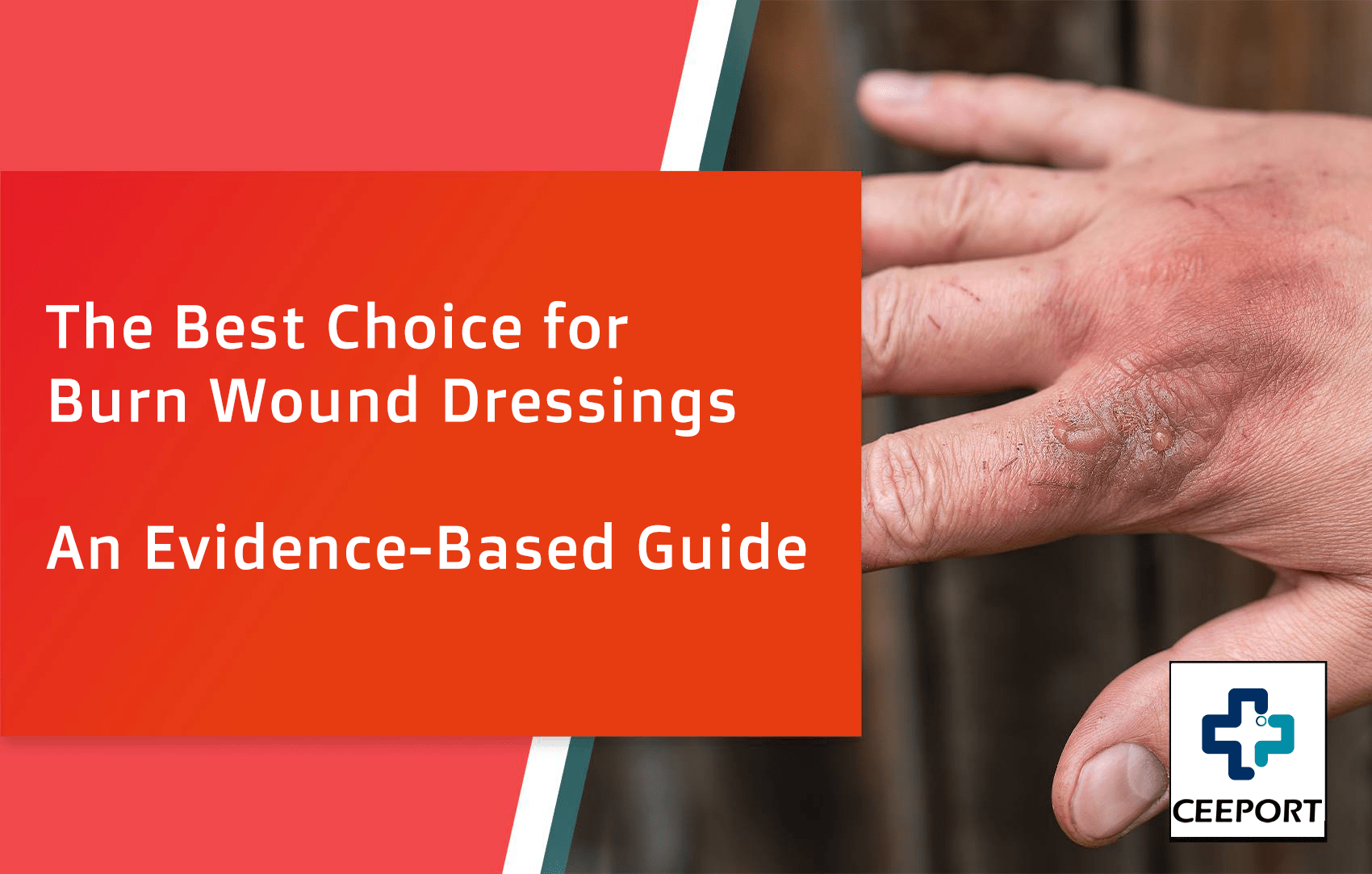The Best Choice for Burn Wound Dressings: An Evidence-Based Guide – CEEPORT